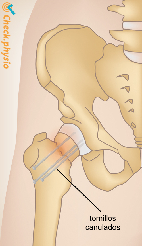 Fractura de cadera | Causa, síntomas y tratamiento
